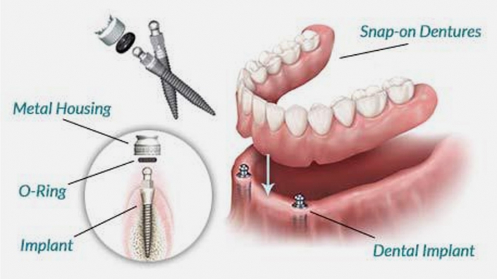 snap-on-dentures | OneSolution Dental Implants