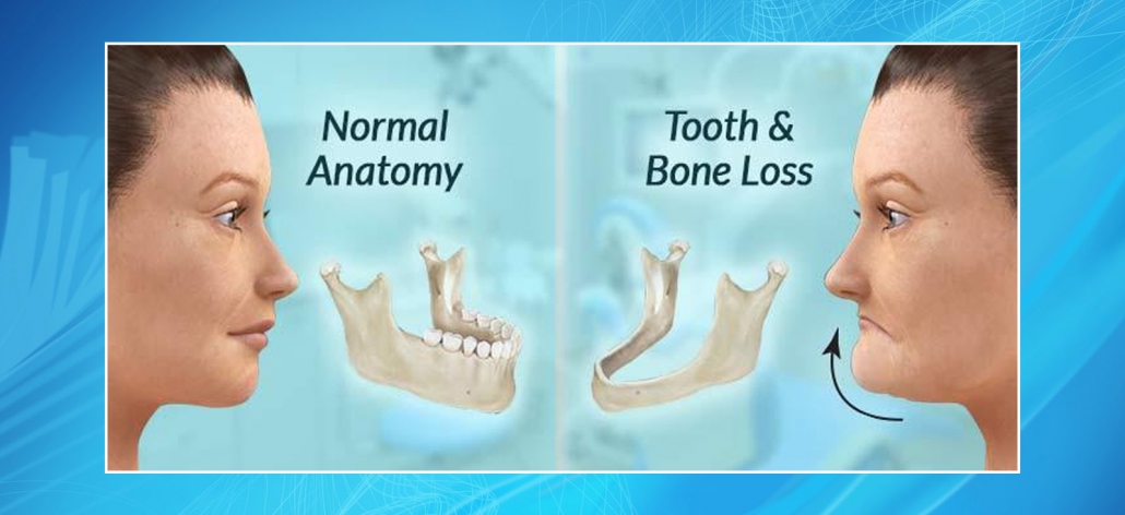 Jawbone Health | 1-877-886-1762 | FDG | OneSolution Dental Implants